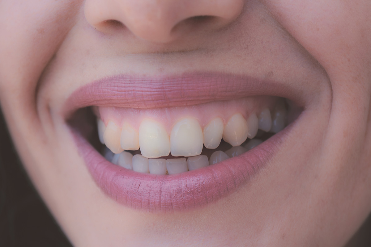 What Causes Receding Gums | Periodontics in Houston, TX